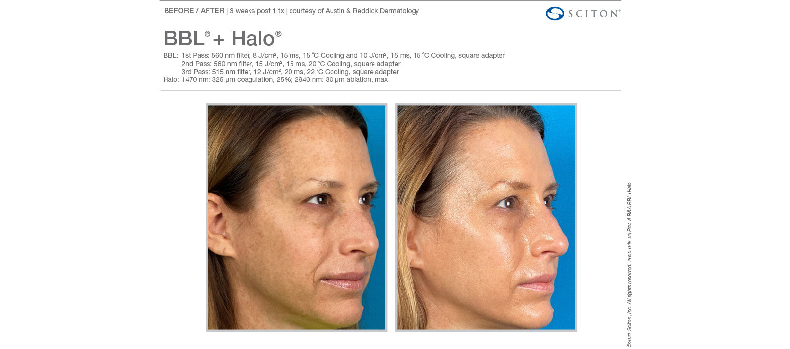 BBL® HERO™ – Custom Glow Spa